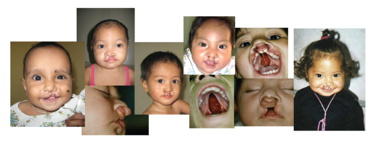 Cleft Prevention International Foundation — About Cleft Lip and Palate ...